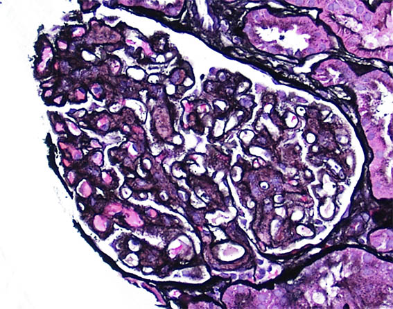 Proteinuria_nefrotica