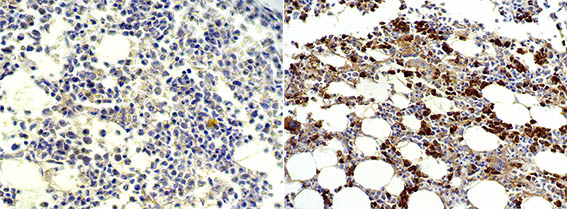 Amyloidosis and Cast Nephropathy