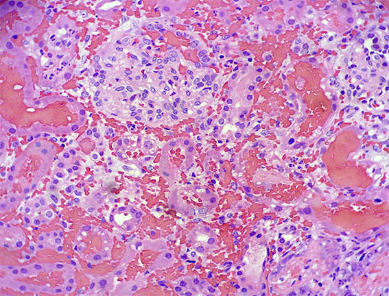 Acute_allograft_dysfunction