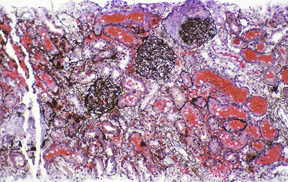 Acute_allograft_dysfunction