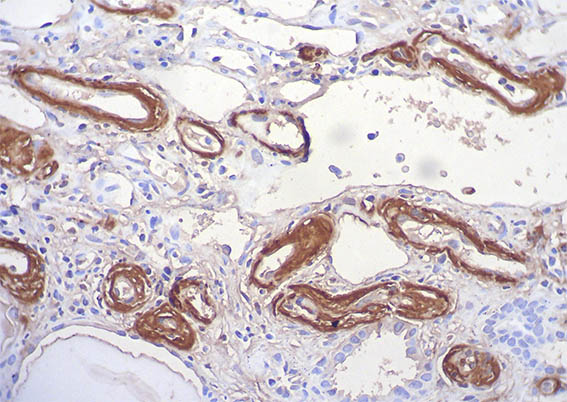 Amiloidosis secundaria (AA)