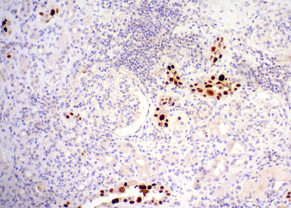 Allograft Dysfunction