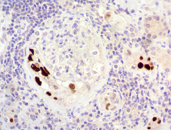 Allograft Dysfunction