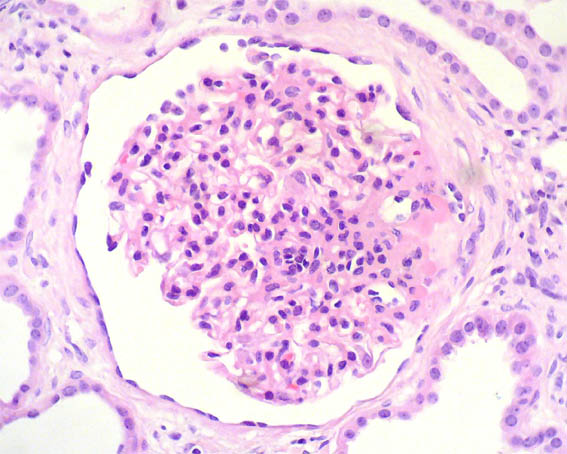 ESKD of unknown cause