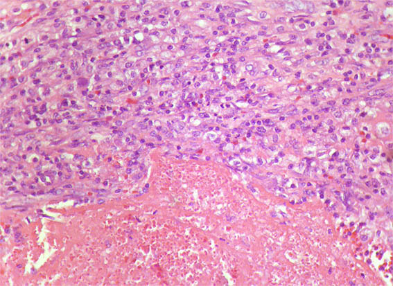 Perihilar Renal Mass