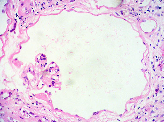 Glomerular cysts