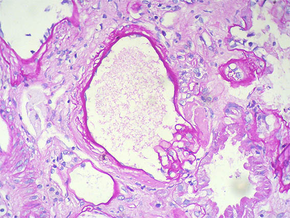 Glomerular cysts