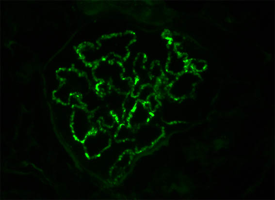 Sindrome nefrotico e hipocomplementemia
