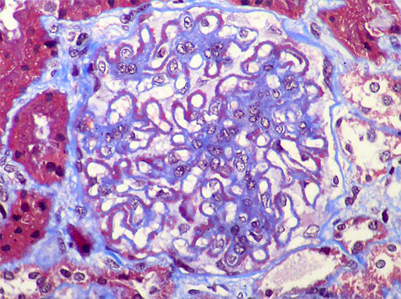 Nephrotic syndrome and hypocomplementemia