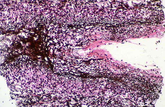 HIV and AKI