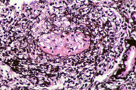 HIV and AKI