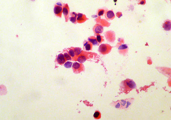 Cellular Casts with Inclusions - Urine