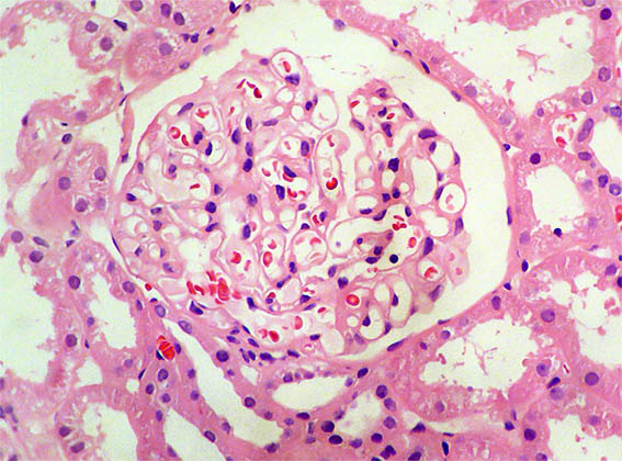 Proteinuria - Glucosuria