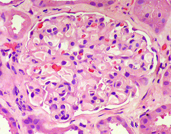 AKI after aneurysm correction