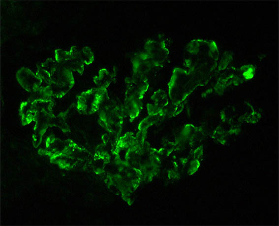 VIH y Sindrome Nefritico
