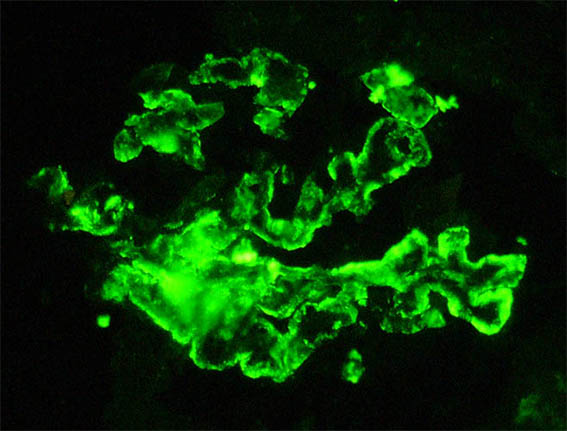 VIH y Sindrome Nefritico