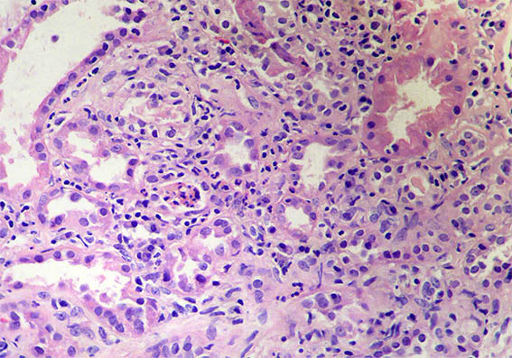 Kidney Graft Dysfunction