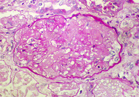 Delayed Graft Function
