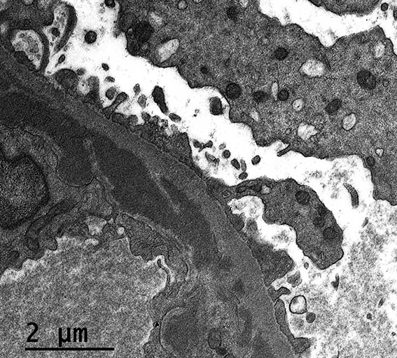 Nephritic syndrome in older