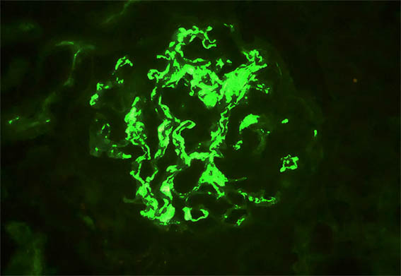 Glomerulopathy and Liver Disease