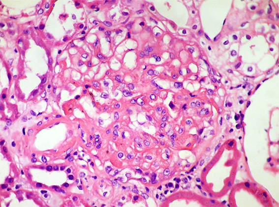 Glomerulopathy and Liver Disease