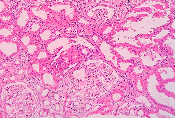 Nephrotic Syndrome and HIV