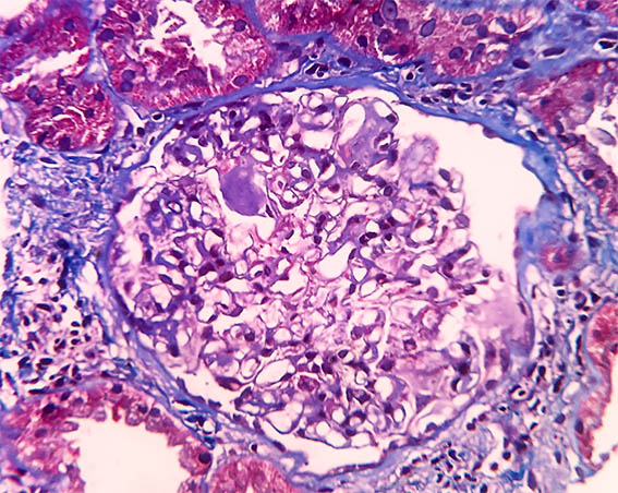 Nephrotic Syndrome and HIV