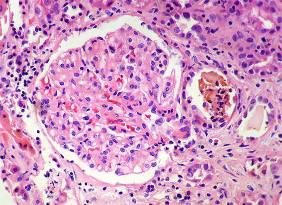Case renal pathology